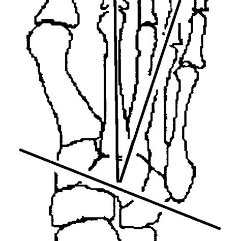 Measurement Of The Metatarsus Adductus Angle Ma Download