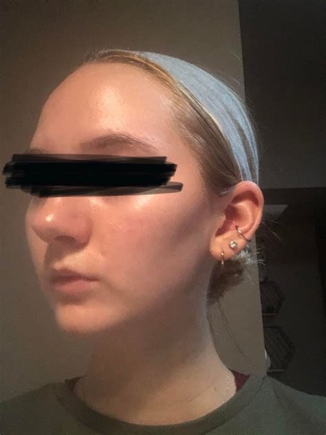 One Week Progress On Tret R Tretinoin