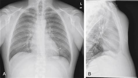 Manubriosternal Joint Injection Clinical Tree