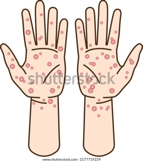 Urticaria Asian Over 5 Royalty Free Licensable Stock Illustrations
