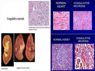 Types Of Necrosis Histology