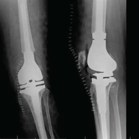 Immediate Postoperative Radiographs Following Hinged Distal Femoral