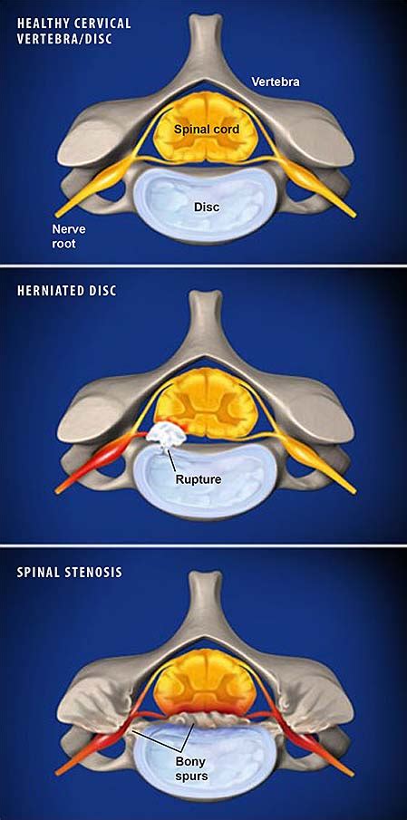 Cervical Radiculopathy Central Coast Orthopedic Medical Group