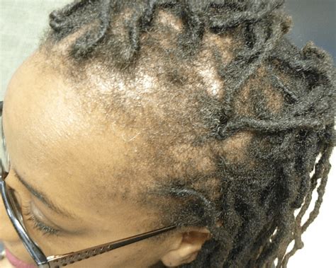 Traction Alopecia And Durag Use Prevention And Treatment Guide