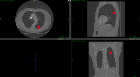 Dicom Lidc Idri Nodules 数据集介绍 知乎
