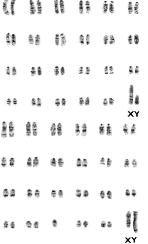 Sex Chromosome Heterochromatin Variation In The Wood Mouse Apodemus