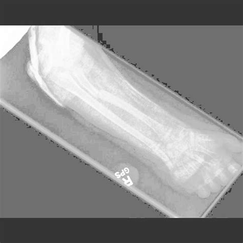 Forearmvalid Object Detection Dataset By Bone Fracture Detection