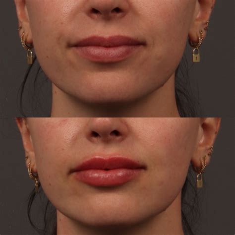 Lip Filler Cheek Filler Botox Brow Lift 7 Before And After Photos In