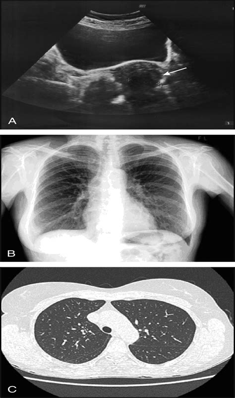 Sarcoidosis Of Female Reproductive Organs In A Postmenopausa Menopause