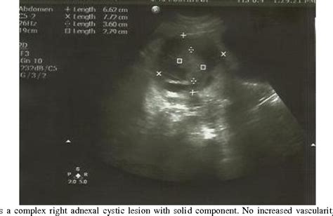 Additional Pathologies Found During Uterine Fibroid Mri