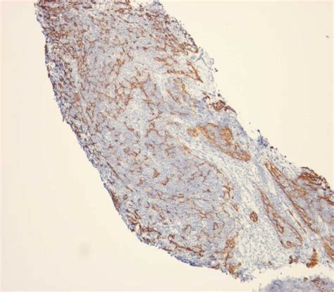 An Unusual Case Of Malignant Invasive Thymoma