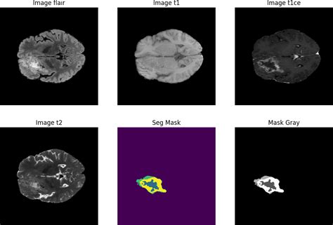 Training 3d U Net For Brain Tumor Segmentation Brats Gli Challenge