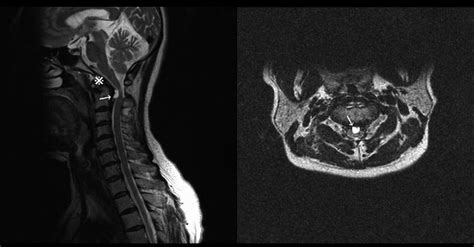Sagittal And Axial Preoperative Magnetic Resonance Imaging Showing Os