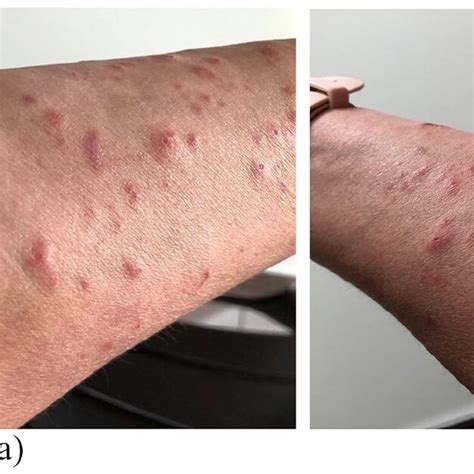 A And B Serpiginous And Clustered Eruption Of Pruritic Papules In