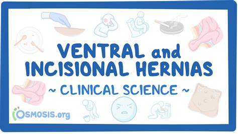 Epigastric Hernia Stock Image C0151639 Science