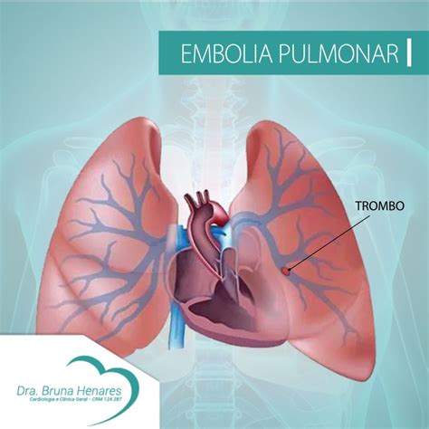 Arquivos Embolia Pulmonar Dra Bruna Henares