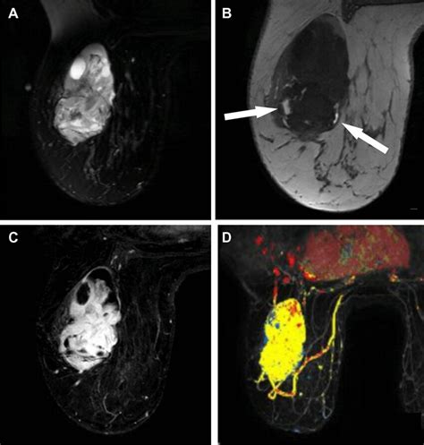 Pump Bump Mri At Harry Stedman Blog