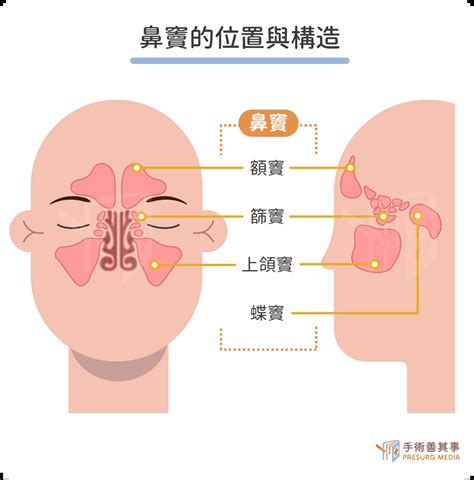 鼻竇炎會傳染嗎？會自己好嗎？症狀、原因、治療、開刀