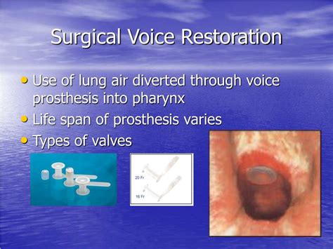 PPT LIFE AFTER HAVING YOUR VOICE BOX REMOVED TOTAL LARYNGECTOMY PowerPoint Presentation ID