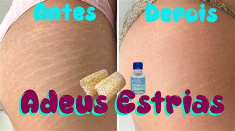 Como Acabar Com As Estrias Imediato De 3 Dias A 2 Semanas VocÊ