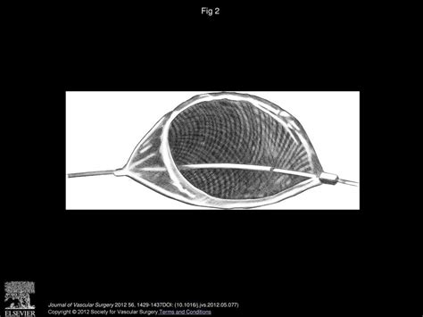 Current Update Of Cerebral Embolic Protection Devices Ppt Download