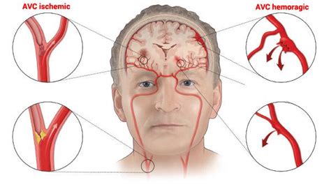 Accident vascular cerebral AVC Simptome tratament și recuperare