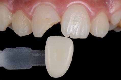 Demystifying Composite Shade Selection With Custom Shade Tabs Dental