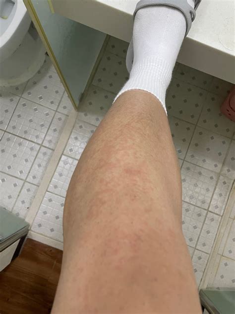 제모 후 피부발진 지식in