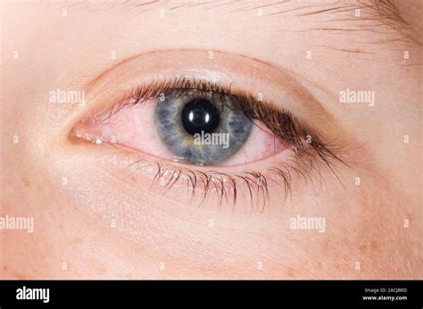 Close Up Of The Reddened Eye In A 14 Year Old Male Patient With