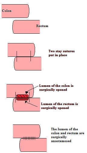 Atresia Coli And Ani Surgical Diagram In Cows Bovis Vetlexicon