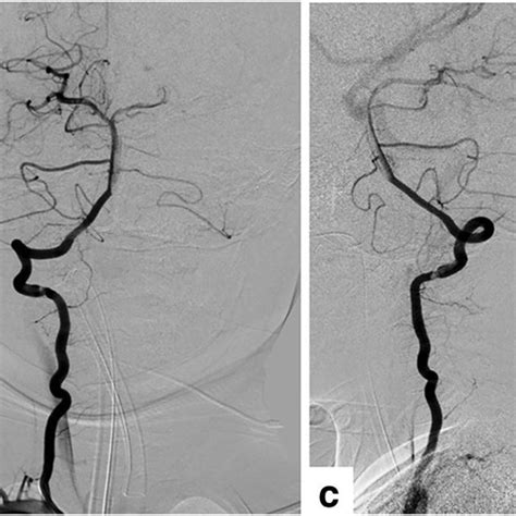 A Schematic Drawing Of The Vertebral Artery Showing Its V3 Segments And Download Scientific