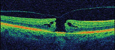 Macular Hole Repair Macular Degeneration Foundation
