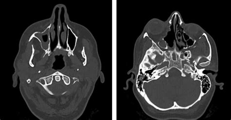Ct Scan Of The Paranasal Sinuses Demonstrated Right Sided Pan Sinus