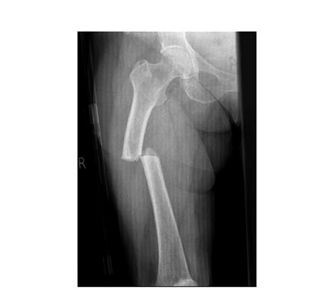 Atypical Femoral Fracture Of The Right Femur Download Scientific Diagram