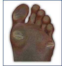 Corns And Calluses The Foot And Ankle Clinic Cornwall Ontario