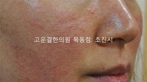 안면 지루성피부염 토닥토닥 고운결한의원 목동점