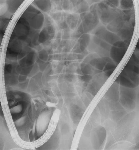 A Foreign Body In The Appendix A Foreign Body In The Appendix