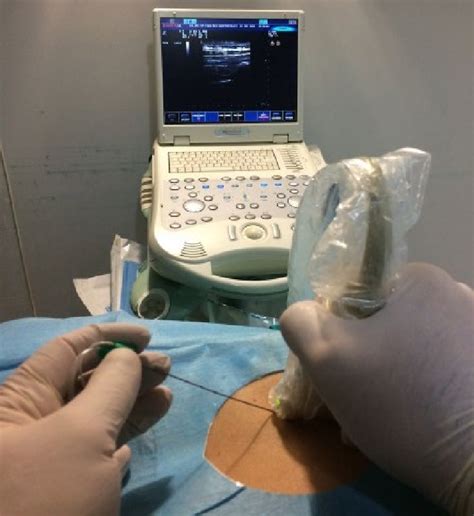 Physician And Patient Position During The Espb Procedure Espb Erector Download Scientific