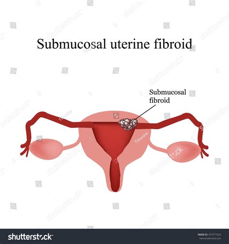 Submucosal Fibroids Endometriosis Infographics Illustration On