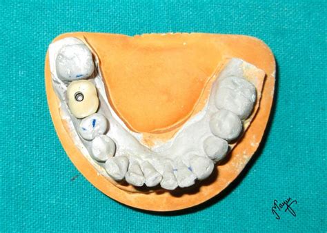 My Todays Case Of Implant Cement Retained Crown Delivery ☺️ Implant