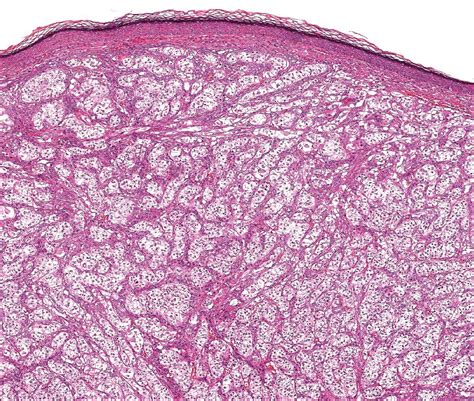 Red Blue Nodule On The Scalp MDedge Dermatology