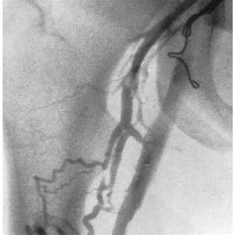A Embolised Left Ovarian Vein Short Arrow Refluxing Dilated Download Scientific Diagram