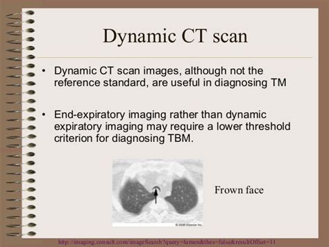 Tracheomalacia