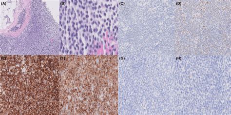 A Hematoxylin And Eosin Hande Staining Shows Breast Tissue