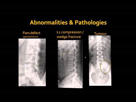 Understanding Common Vertebral Column Abnormalities In Radiology