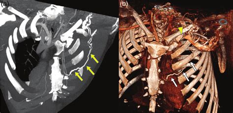 A The Evident Venous Collateral Circle Yellow Arrows B