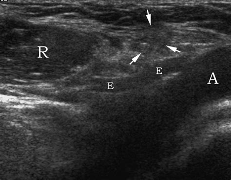 Indirect Inguinal Hernia Ultrasound