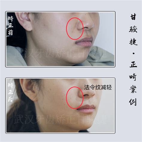 甘骏捷的正畸唠嗑隐适美矫正纠正嘴突改善面型 知乎