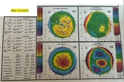 8 Month Tg Prk Cxl Athens Protocol Check Up R Keratoconus