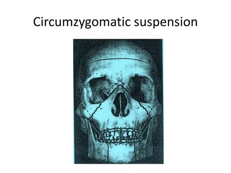 Transosseus Wiring Circumferential Wiring Dentoalveolar Fracture Pptx